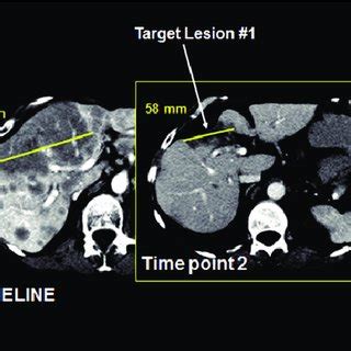 Comparison Of The Target And Non Target Lesions Download Scientific Diagram