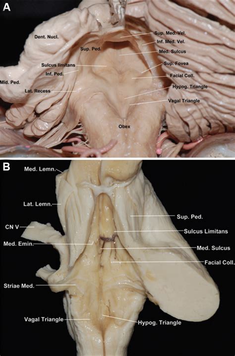 Sulcus Limitans Brainstem