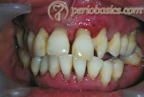 Diabetes And Periodontitis A Bidirectional Relationship