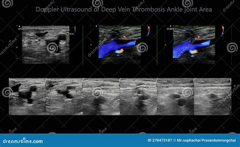 Color Doppler Ultrasound Determination In Deep Vein Thrombosis Patients
