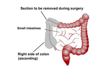 Right Hemicolectomy Dr Ashutosh Soni