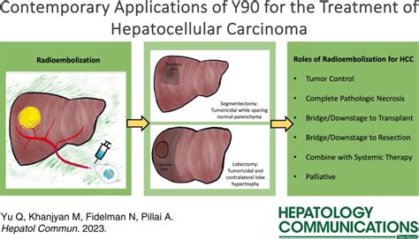 Contemporary Applications Of Y90 For The Treatment Of Hepatocellular Carcinoma Pmc