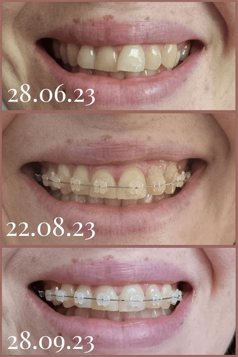 Progress 2 Months In To 18 Month Treatment Already Seeing So Much
