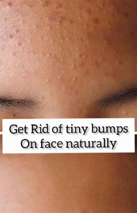 Remove Tiny Bumps On Face At Home Healthy Quotes White Bumps On Face Face