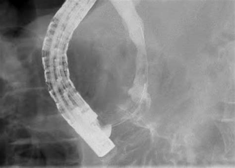 Ercp Confirmed The Presence Of An Infiltrative Mass Involving The Major