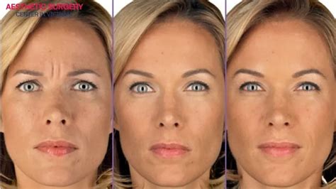 Understanding The Botox Smile Lift Things You Need To Know