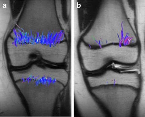 Fiber Tracts Correlate To Height Gain Diffusion Tensor Imaging