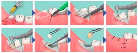 Wisdom Tooth Extraction Understanding The Healing Process