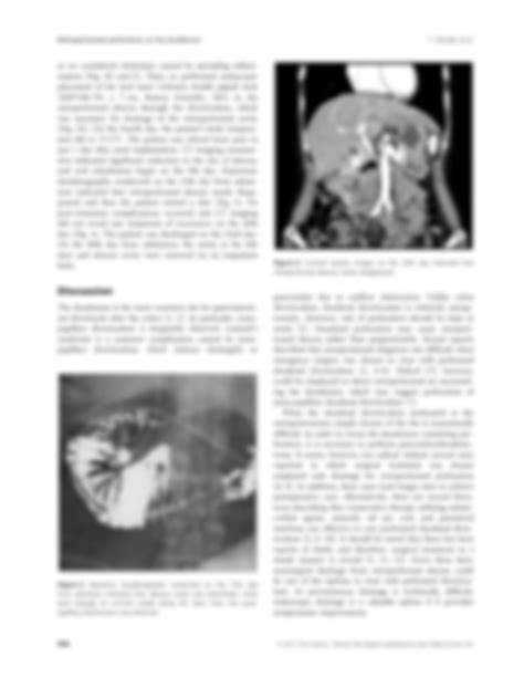 Solution Retroperitoneal Perforation Arising From Duodenal