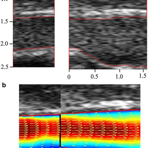 In Vivo Measurement Of The Velocity In A Carotid Artery Using