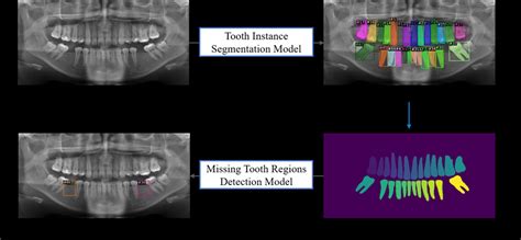 entire process for missing tooth region detection tooth instance