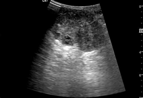 Radiopaedia Case Soft Tissue Sarcoma Buttock Id 70486 Study 80604