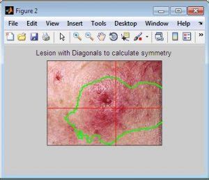 Skin Cancer Detection Using Matlab Image Processing Projects