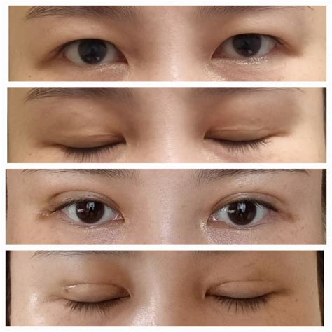 절개쌍커풀 수술후 자연유착으로 재수술 리얼후기 눈이 예쁘다그래서 아몬드성형외과