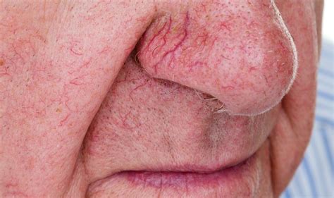 Three Symptoms Of Liver Scarring May Show Up On The Skin Uk