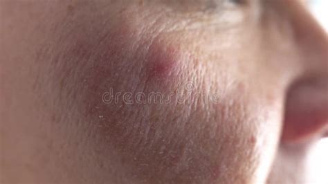 Close Up Of An Abscess From An Insect Bite On A Woman S Leg A Woman