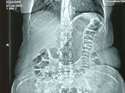 GIST Gastrointestinal Stromal Tumor Ppt
