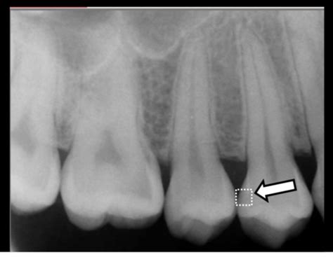 Caries On X Ray