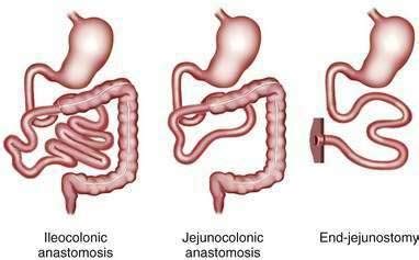 Short Bowel Syndrome Abdominal Key