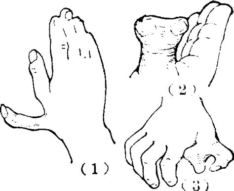 多指 整形外科学 医学