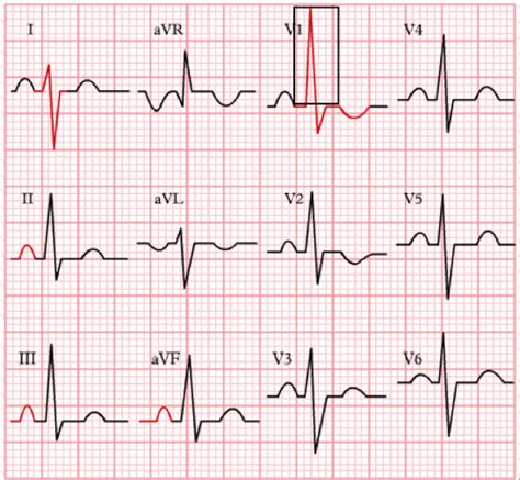 Ecg Flashcards Quizlet