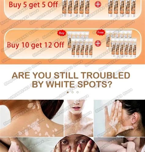 Крем для лечения винограда мазь для роста меланина быстрое удаление белых пятен 20 г Aliexpress