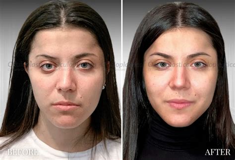 Canthoplasty Looksmax Should You Get Surgery To Enhance Your Eye Shape