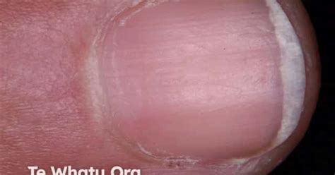 Nail Dystrophy Due To Lichen Planus Image