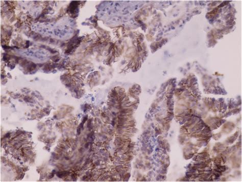 Her2 Cells Showing Immunostaining Score 3⁺ Complete And Intense Download Scientific Diagram