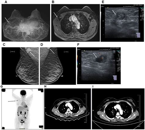 Frontiers Case Report A Panorama Gene Profile Of Ovarian Cancer