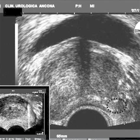 Pdf Transrectal Ultrasound Trus And Trus Biopsy Accuracy In