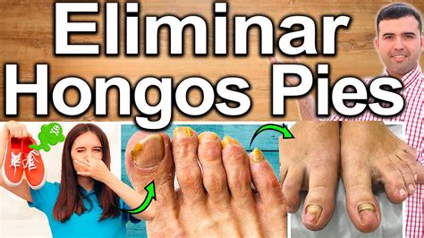 CÓmo Eliminar Hongos En Los Pies Elimina El Pie De Atleta En 1 Semana