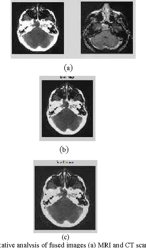 Figure 1 From Pca Dwt Based Medical Image Fusion Using Non Sub Sampled Contourlet Transform
