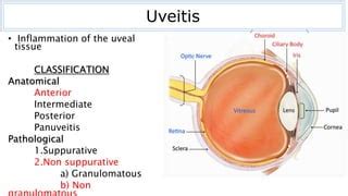 Anterior Uveitispptx