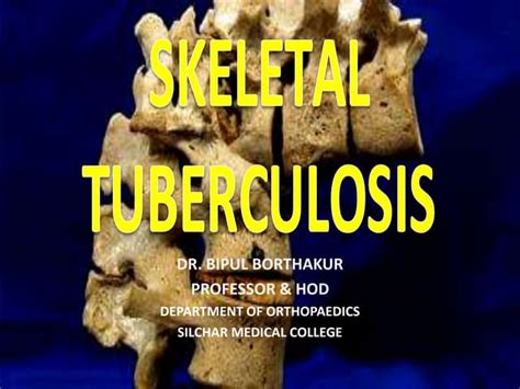 Skeletal Tuberculosis Pptx