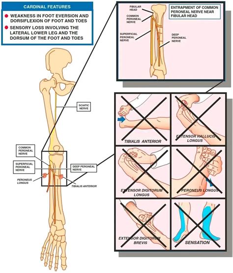 Georgios Kakavas On Linkedin Peroneal Or Fibular Neuropathy Is The