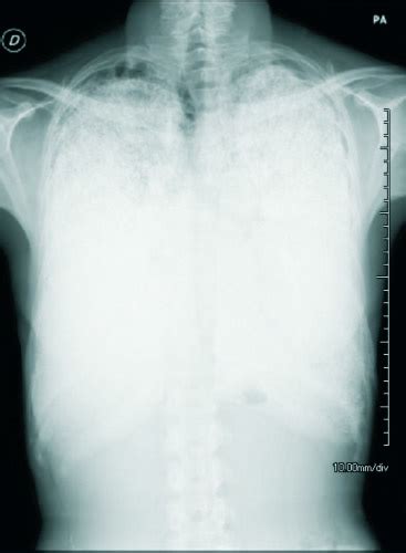 Clinical Cases Chest Woman 40 Years Old Diffuse Lung Opacification On Routine Radiographs