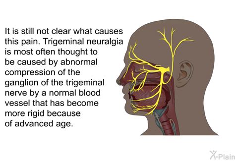 Trigeminal Neuralgia