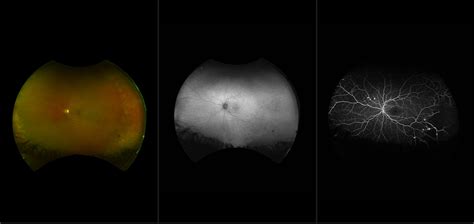 Diabetic Macular Edema Case Study