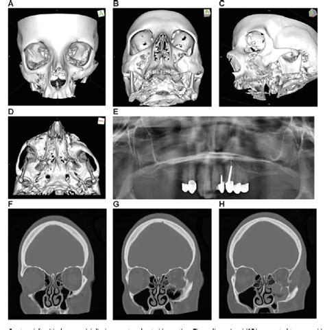 Figure 1 From The Comprehensive Aocmf Classification System Midface
