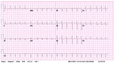 Typical Atrial Flutter Icd 10 Venturekiza