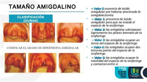 Amigdalitis
