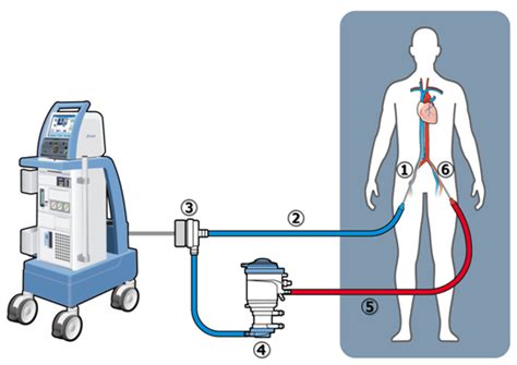 Ecmo（エクモ）回路とシステムの構成について Mera 泉工医科工業株式会社 ―医療と共に歩む、信頼のメラ製品―