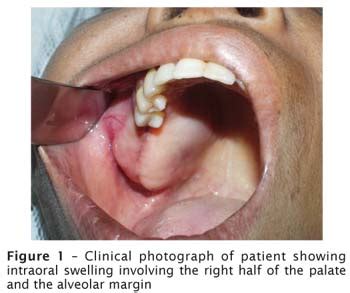 Fibrous Dysplasia Maxilla