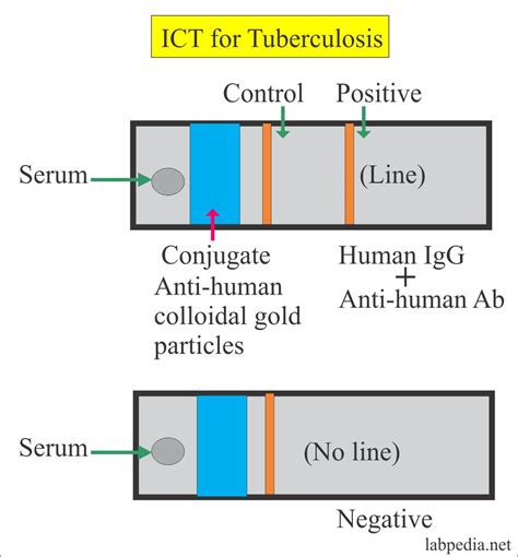 Mycobacterium Tuberculosis Part 7 Tuberculosis Test By Ict Immunochromatography Technique