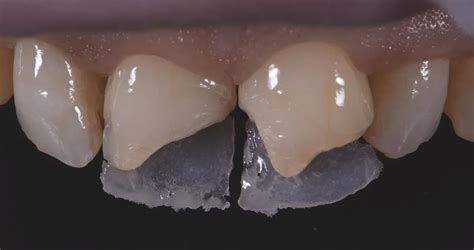 Quick Anterior Restoration In Everyday Practice Kuraray Dental