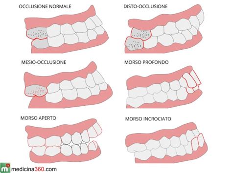 Malocclusione Mandibolare Sintomi Lyifam