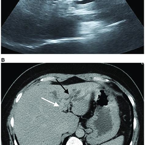 Ultrasound Image And Compute Tomography In Cholangiocarcinoma Cca Download Scientific