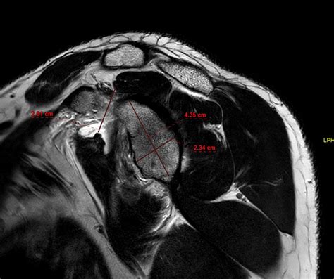 The Measurement Of The Glenoid Width Height And The Rotator Interval Download Scientific