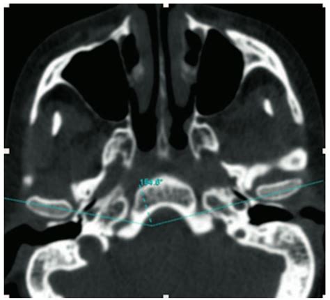 Perpendicular Axial Ct Imaging In Both Condyles The Blue